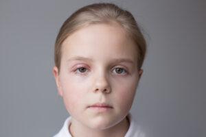 Jačmeň na oku – priebeh, trvanie, liečba - Vmagazin.sk
